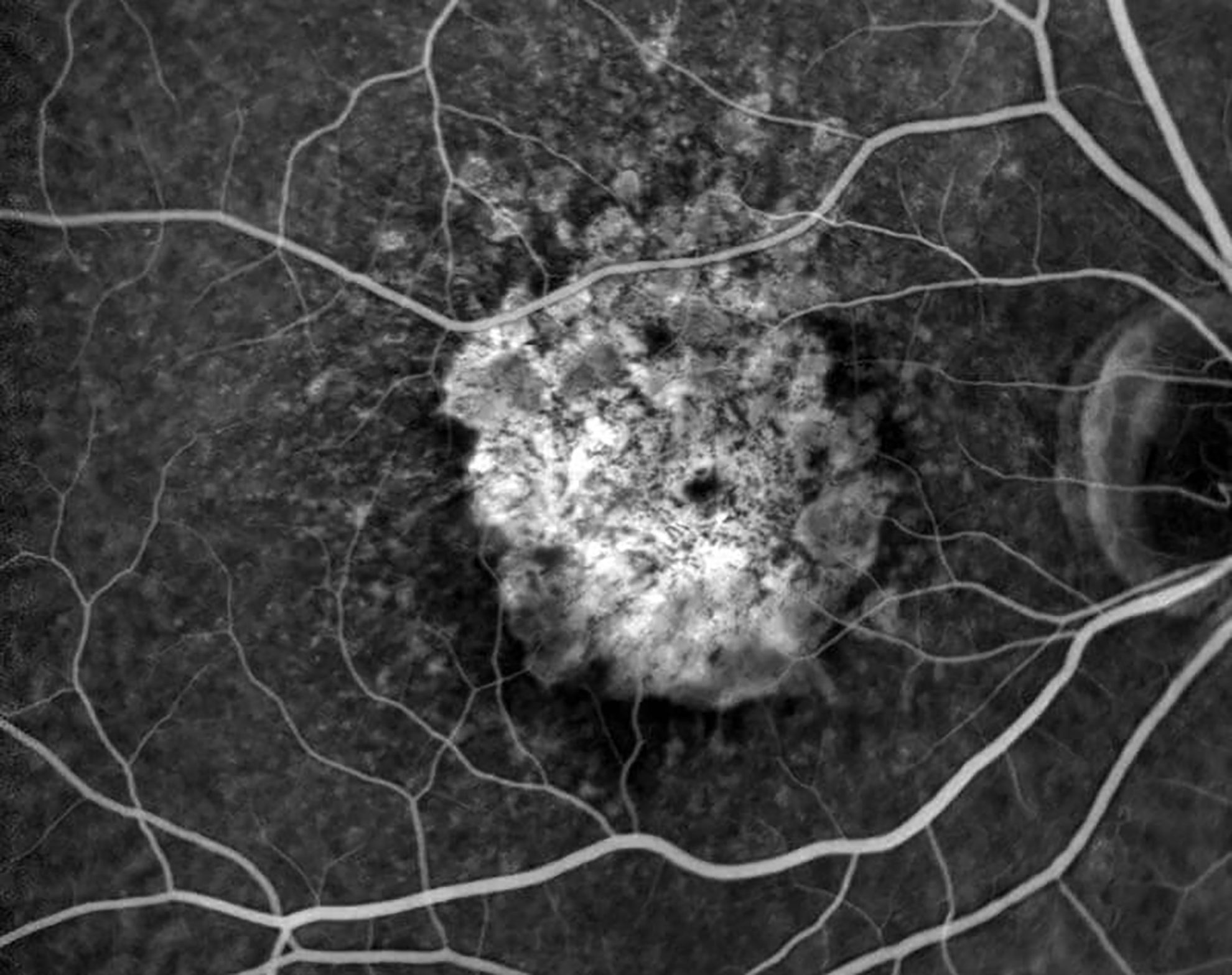 altersbedingte Makuladegeneration (AMD) - augencentrum-dresden.de