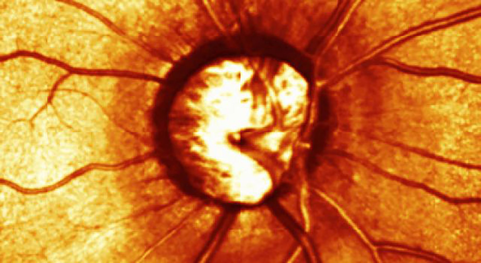 Heidelberg Retina Tomographie (HRT) - augencentrum-dresden.de