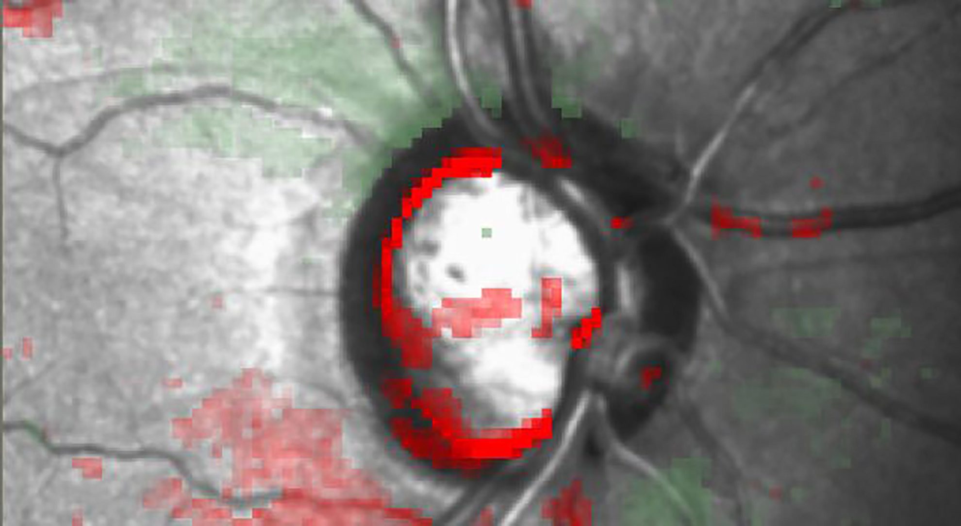 Heidelberg Retina Tomographie (HRT) - augencentrum-dresden.de