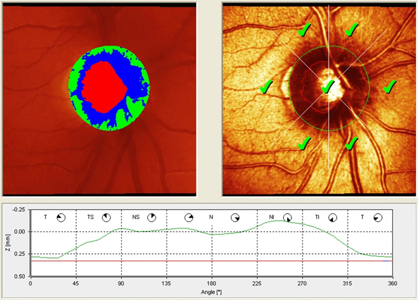 Heidelberg Retina Tomographie (HRT) - augencentrum-dresden.de