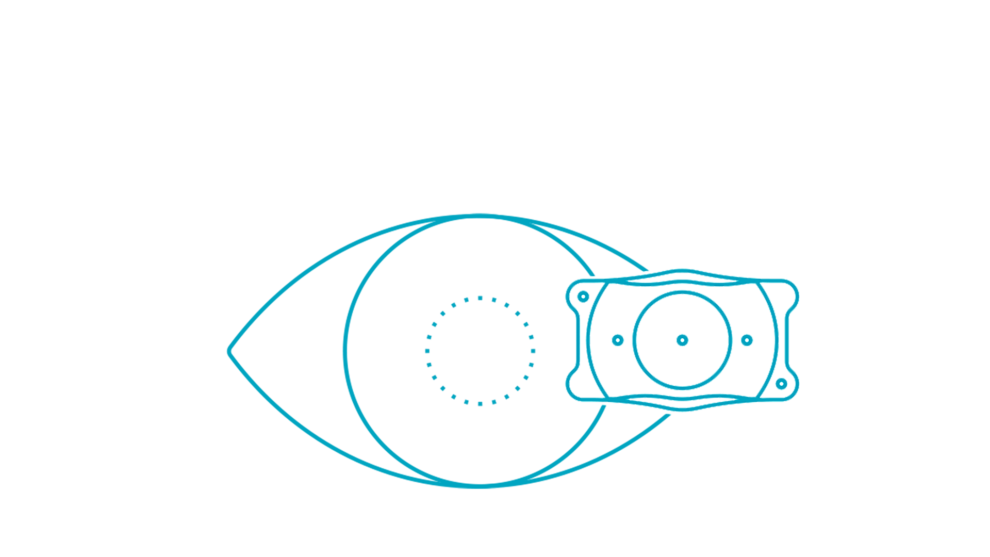 EVO Visian ICL (IPCL, Phake-Linse) | Linsenimplantation | Dresden